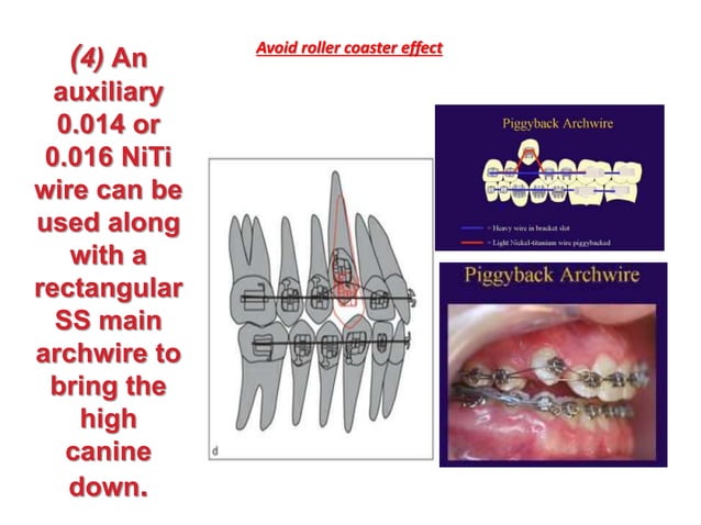 selection of preformed archwires during the alignment stage of ...