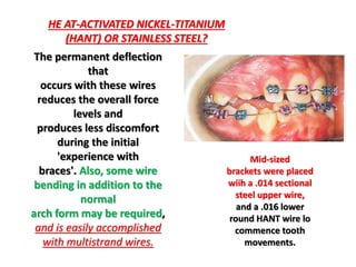 Preformed Archwire Spring Ballista