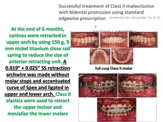 Preformed Archwire Spring Ballista