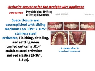 Preformed Archwire Spring Ballista