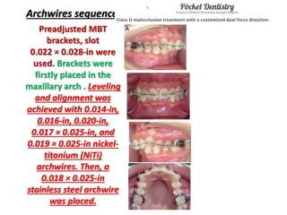 Preformed Archwire Spring Ballista