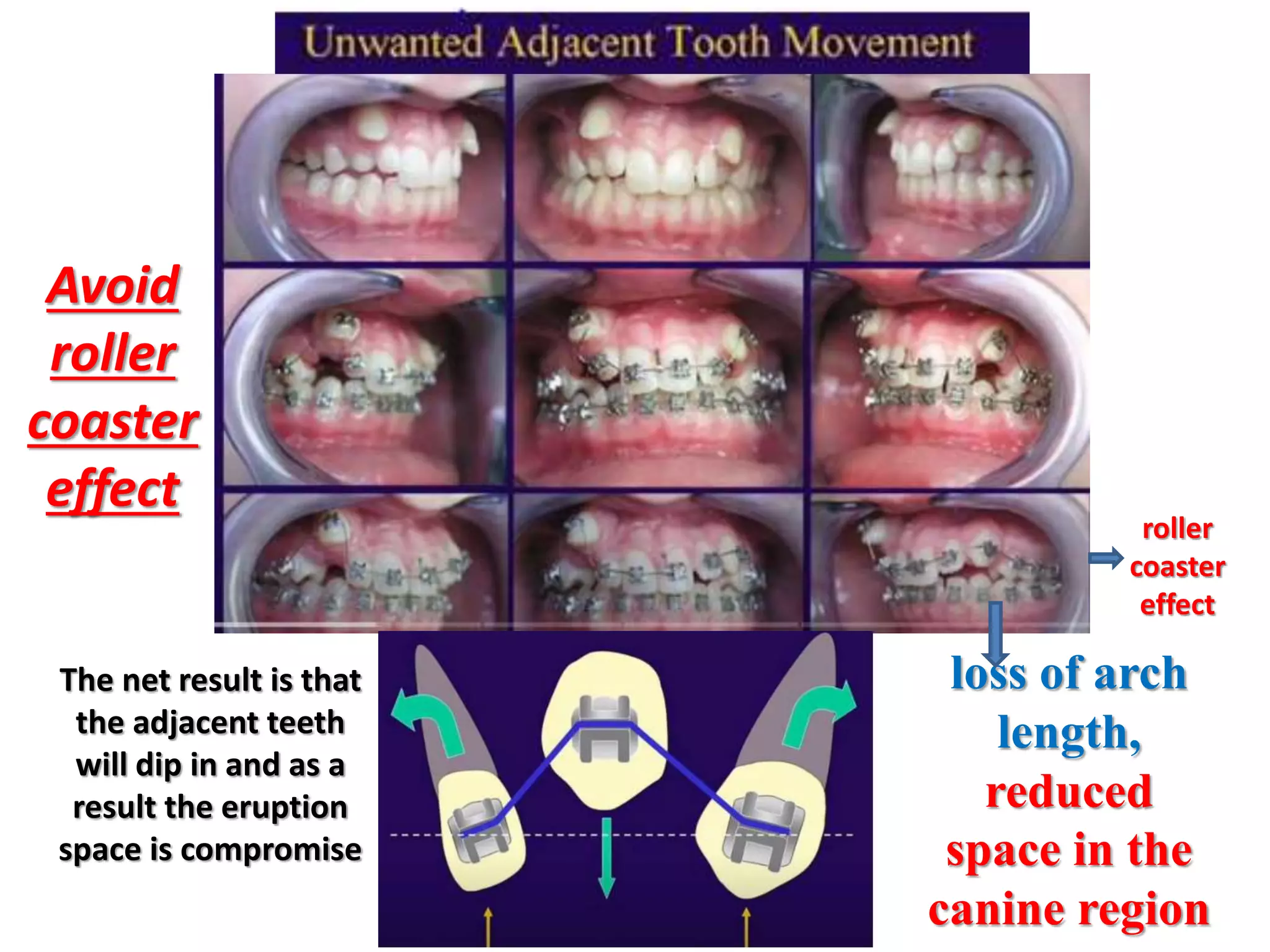 selection of preformed archwires during the alignment stage of ...