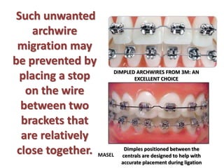 selection of preformed archwires during the alignment stage of ...