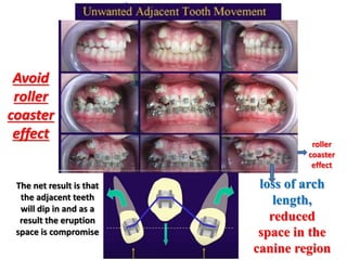 Preformed Archwire Spring Ballista