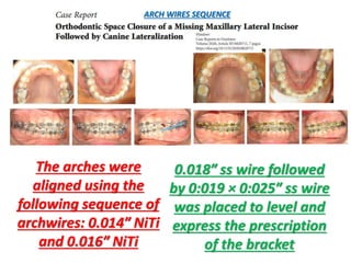 Preformed Archwire Spring Ballista