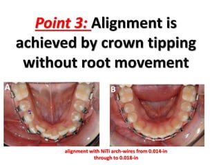 Preformed Archwire Spring Ballista