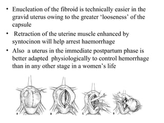 Selective cesarean myomectomy | PPT