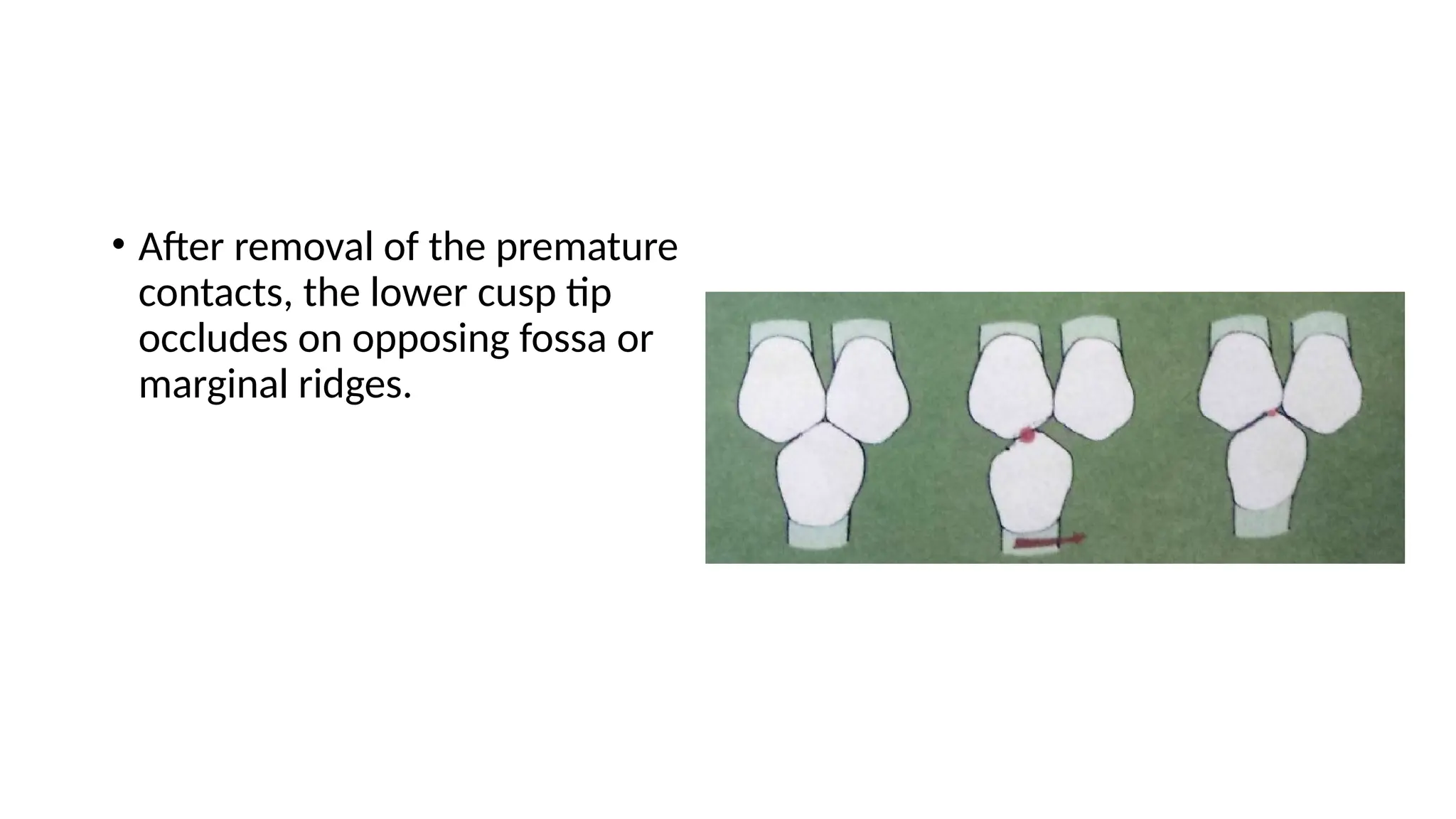Selective grinding for occlusion adjustment pptx | PPTX