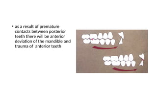 Selective grinding for occlusion adjustment pptx | PPTX