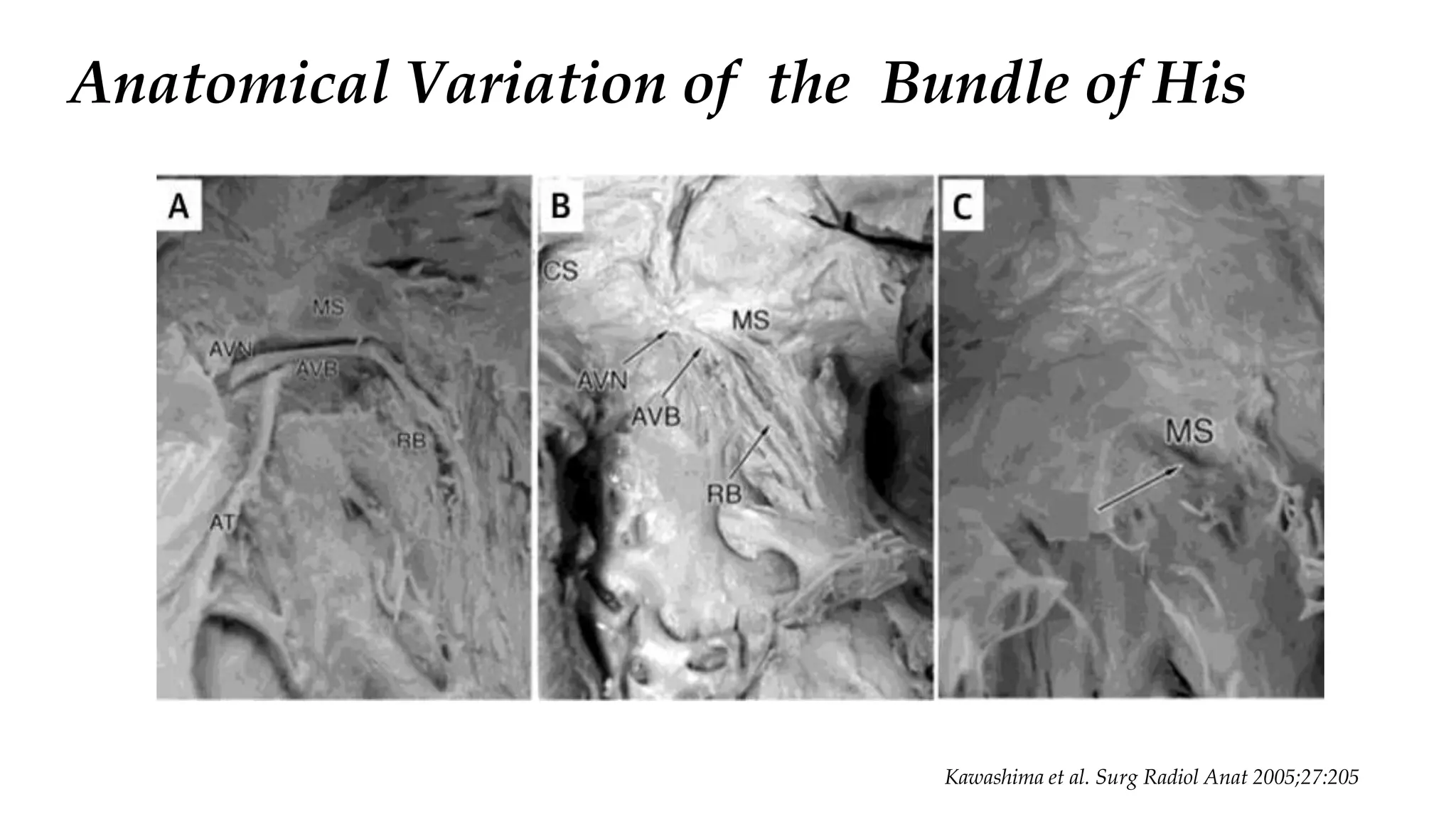 Selective vs nonselective his bundle capture | PPTX