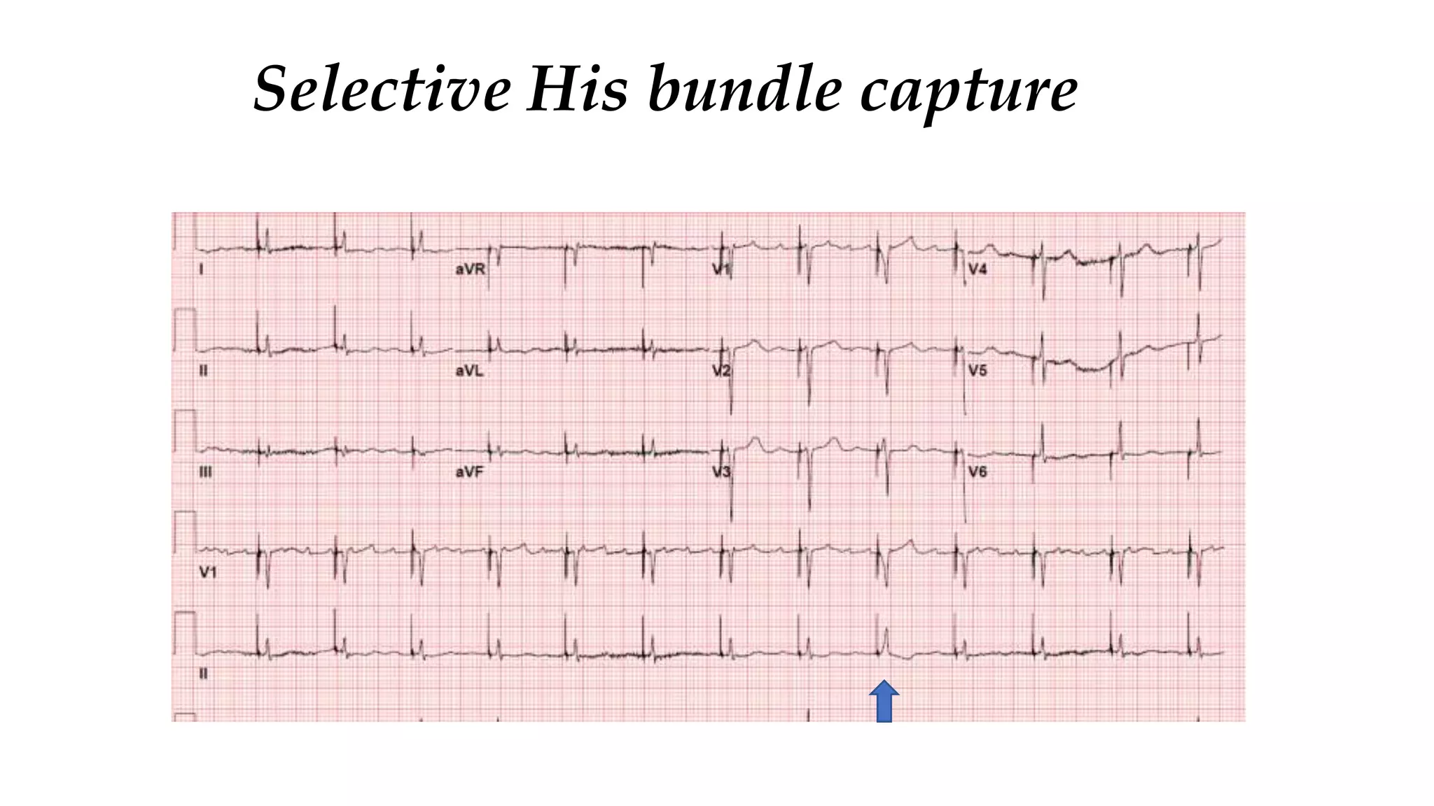 Selective vs nonselective his bundle capture | PPTX