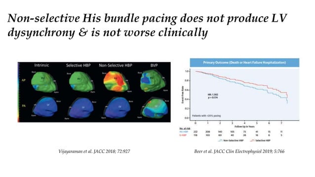 Selective vs nonselective his bundle capture | PPTX