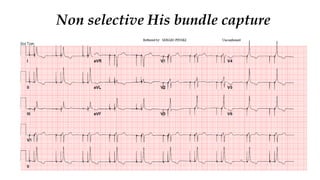 Selective vs nonselective his bundle capture | PPT