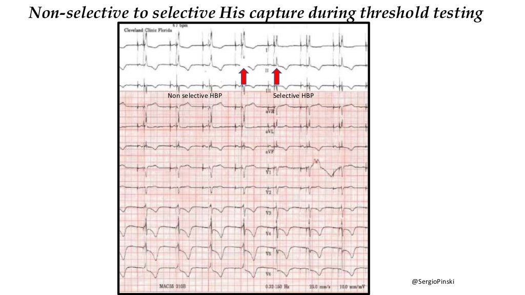 Selective vs nonselective his bundle capture