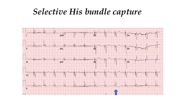 Selective vs nonselective his bundle capture