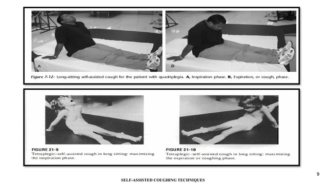 SELF-ASSISTED COUGHING TECHNIQUES IN PHYSIOTHERAPY.pptx