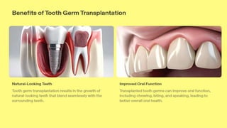 odontoplasty and transplantation of tooth germs | PPTX