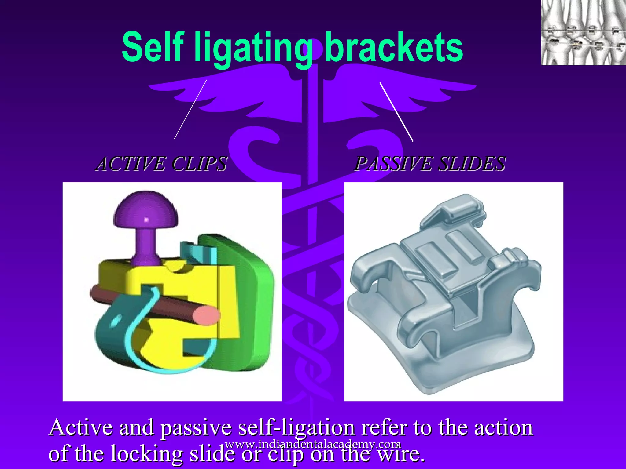 Self ligating brackets | PPT