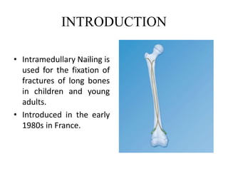 FLEXIBLE INTRAMEDULLARY NAILS FOR FRACTURES IN CHILDREN | PPTX ...