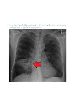 Lung Abscess X Ray
