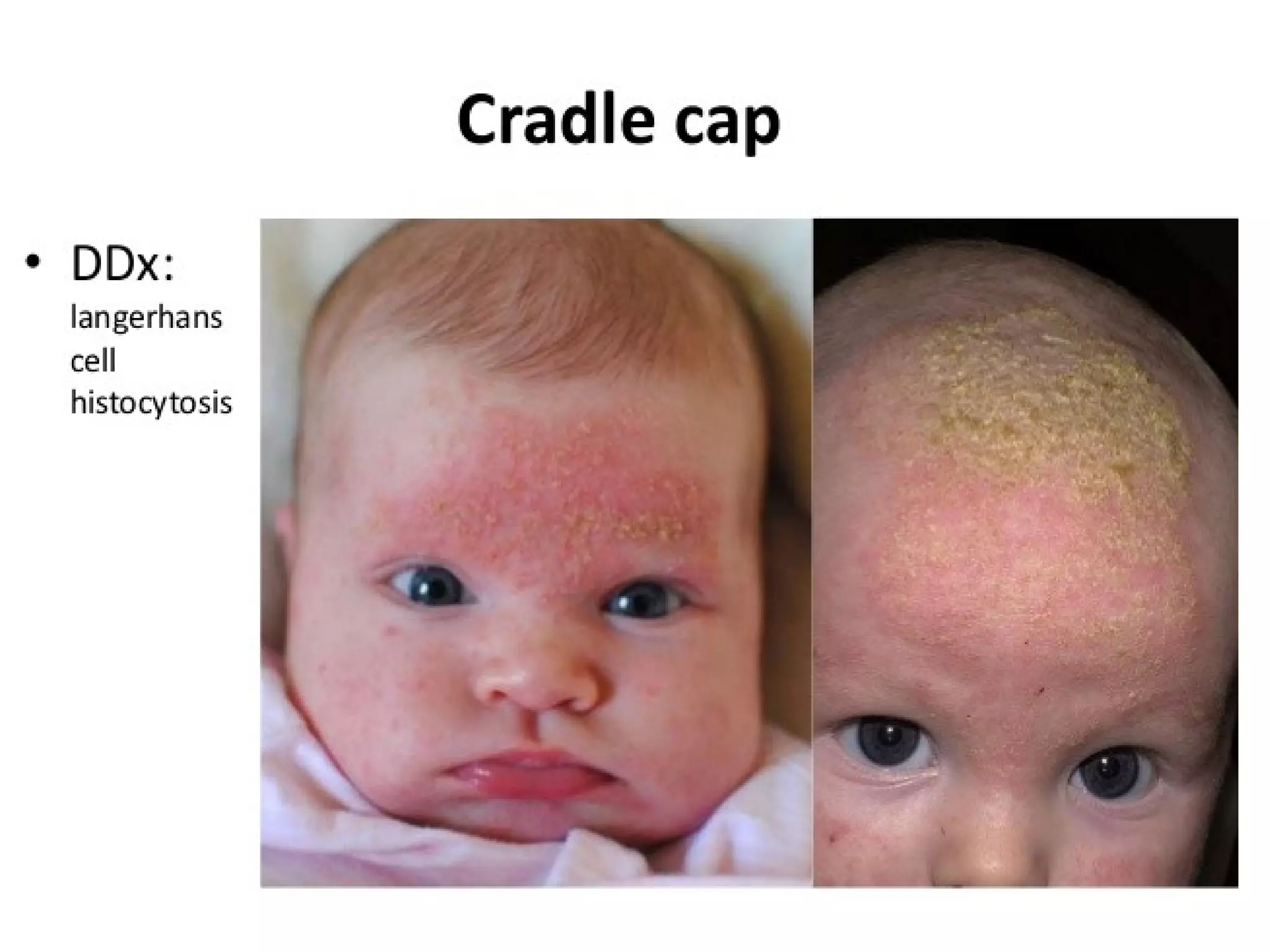 Seborrheic dermatitis | PPT