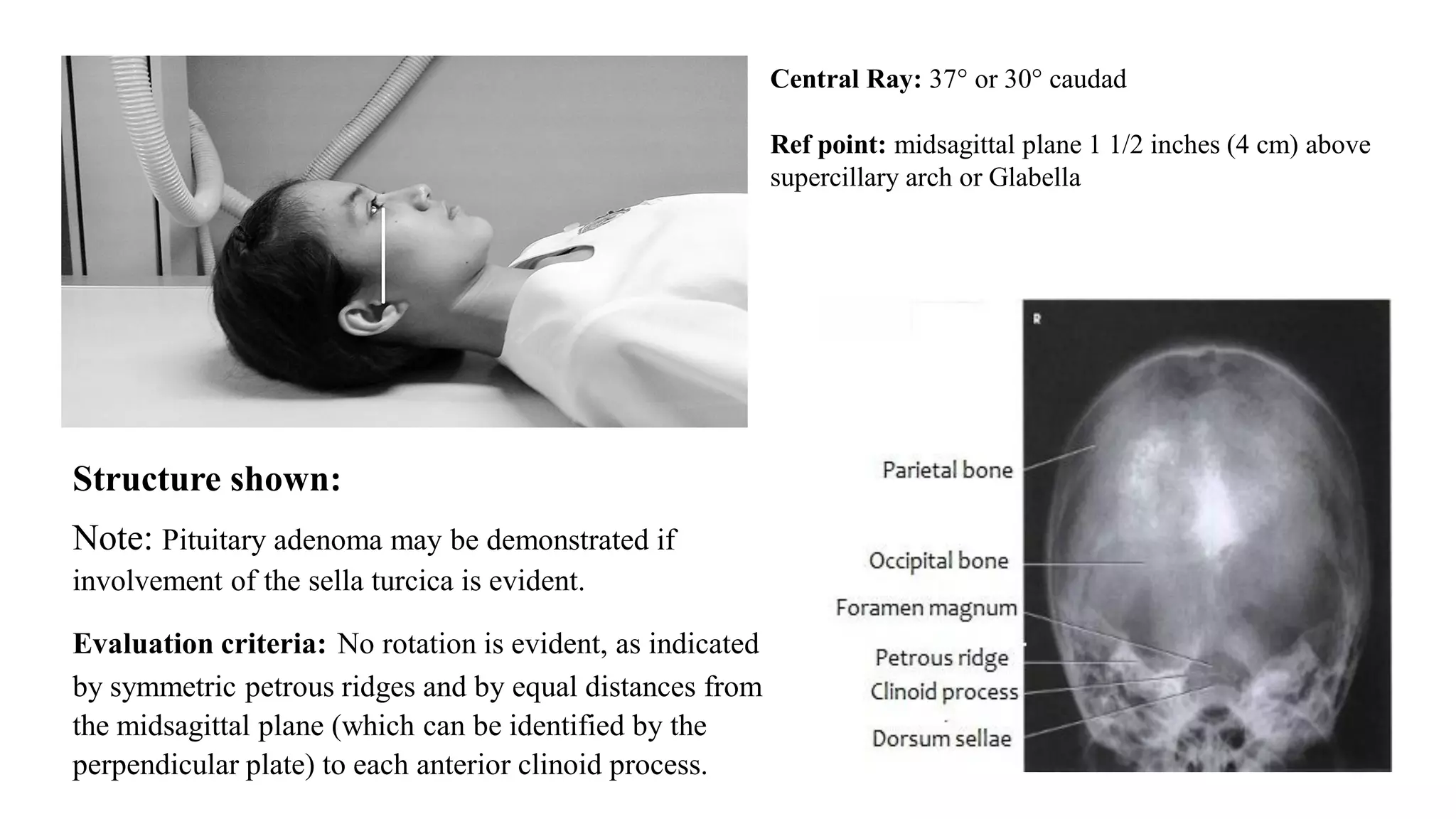 Sella Turcica (RAD31) | PDF