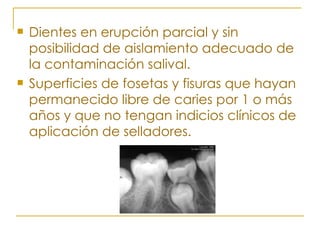 Selladores de fosetas y fisuras | PPS | Oral care | Personal Care