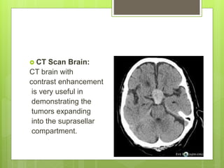 Sellar/ suprasellar tumors | PPTX