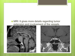 Sellar/ suprasellar tumors | PPTX