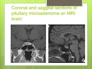 Sellar/ suprasellar tumors | PPTX
