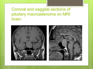 Sellar/ suprasellar tumors | PPTX