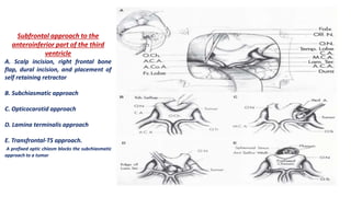 Sellar anatomy copy | PPT