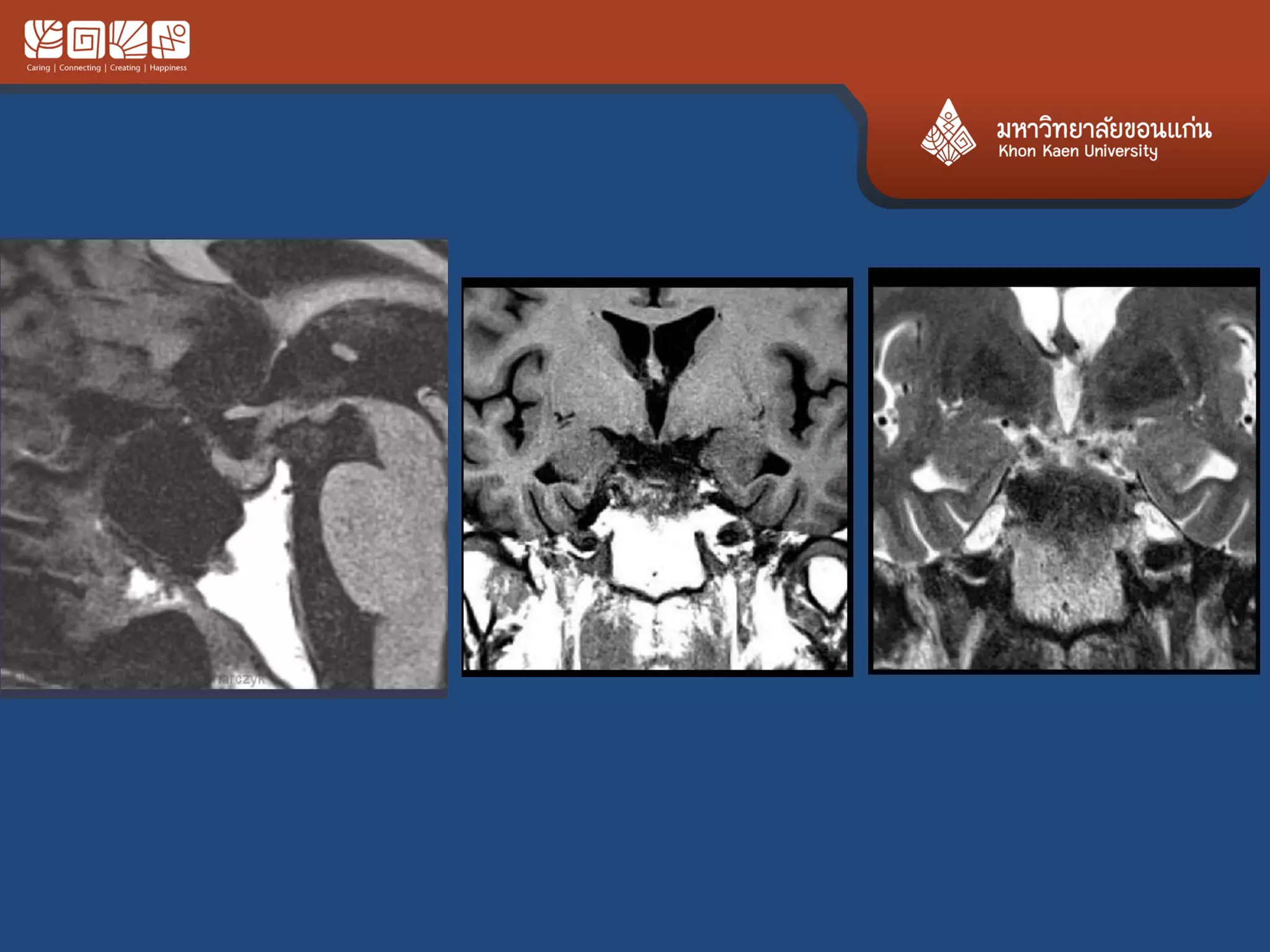 Sellar and parasellar tumor | PDF