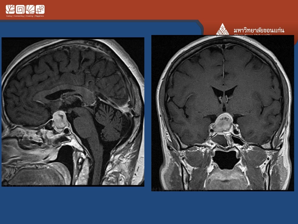 Sellar and parasellar tumor