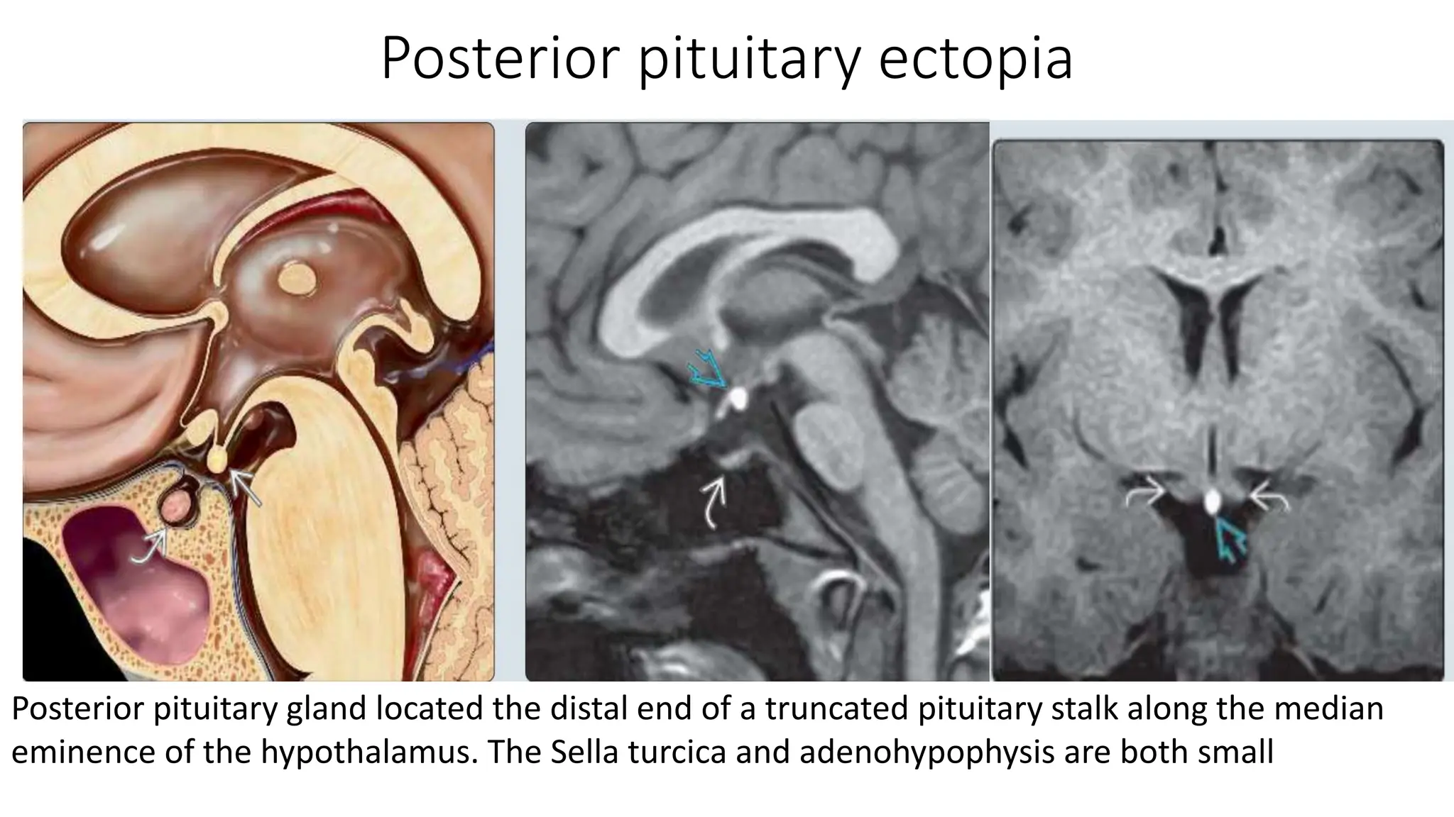 Sellar And Suprasellar Mass Pituitary Gland Pptx