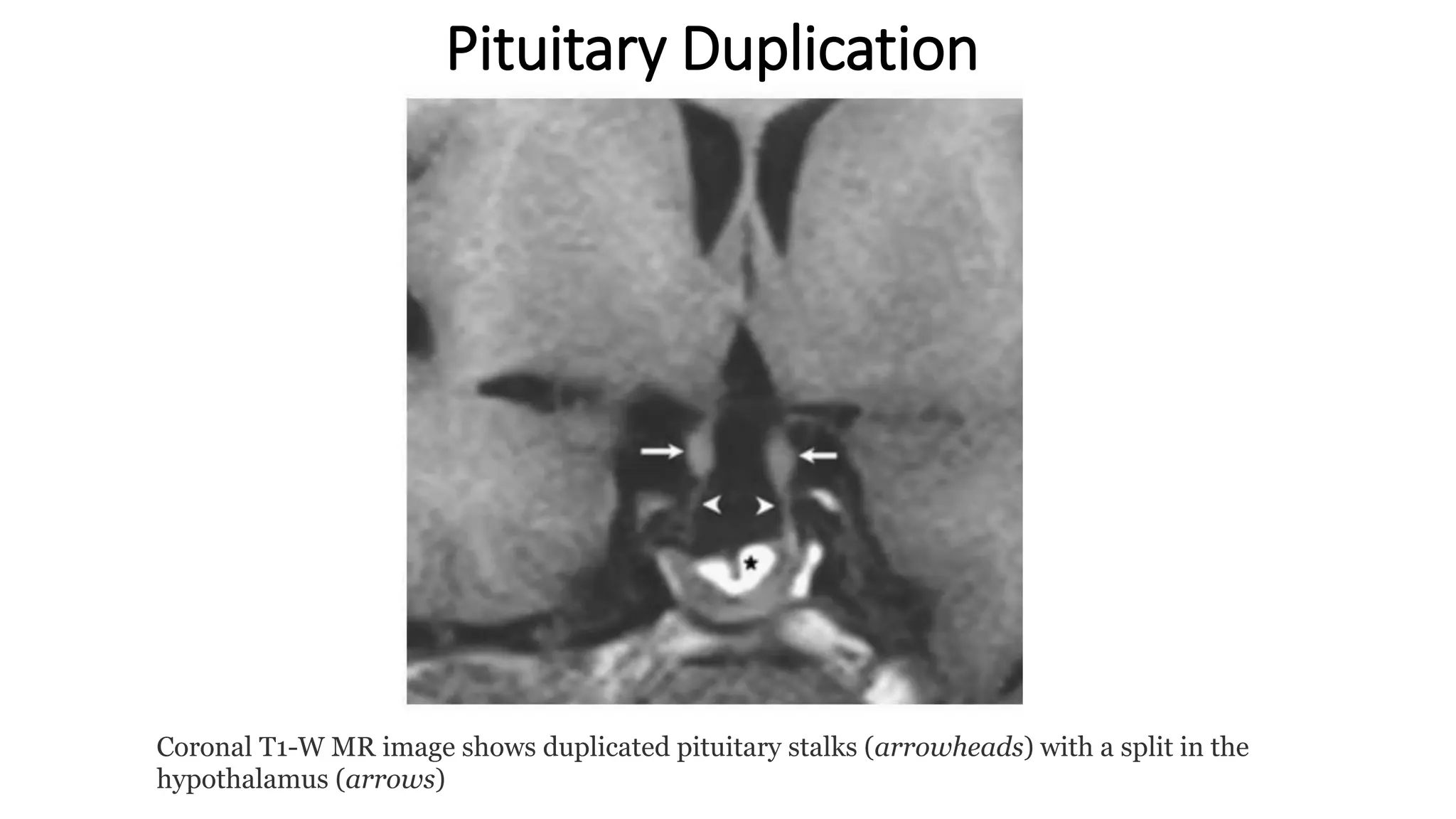 sellar and suprasellar mass pituitary gland .pptx