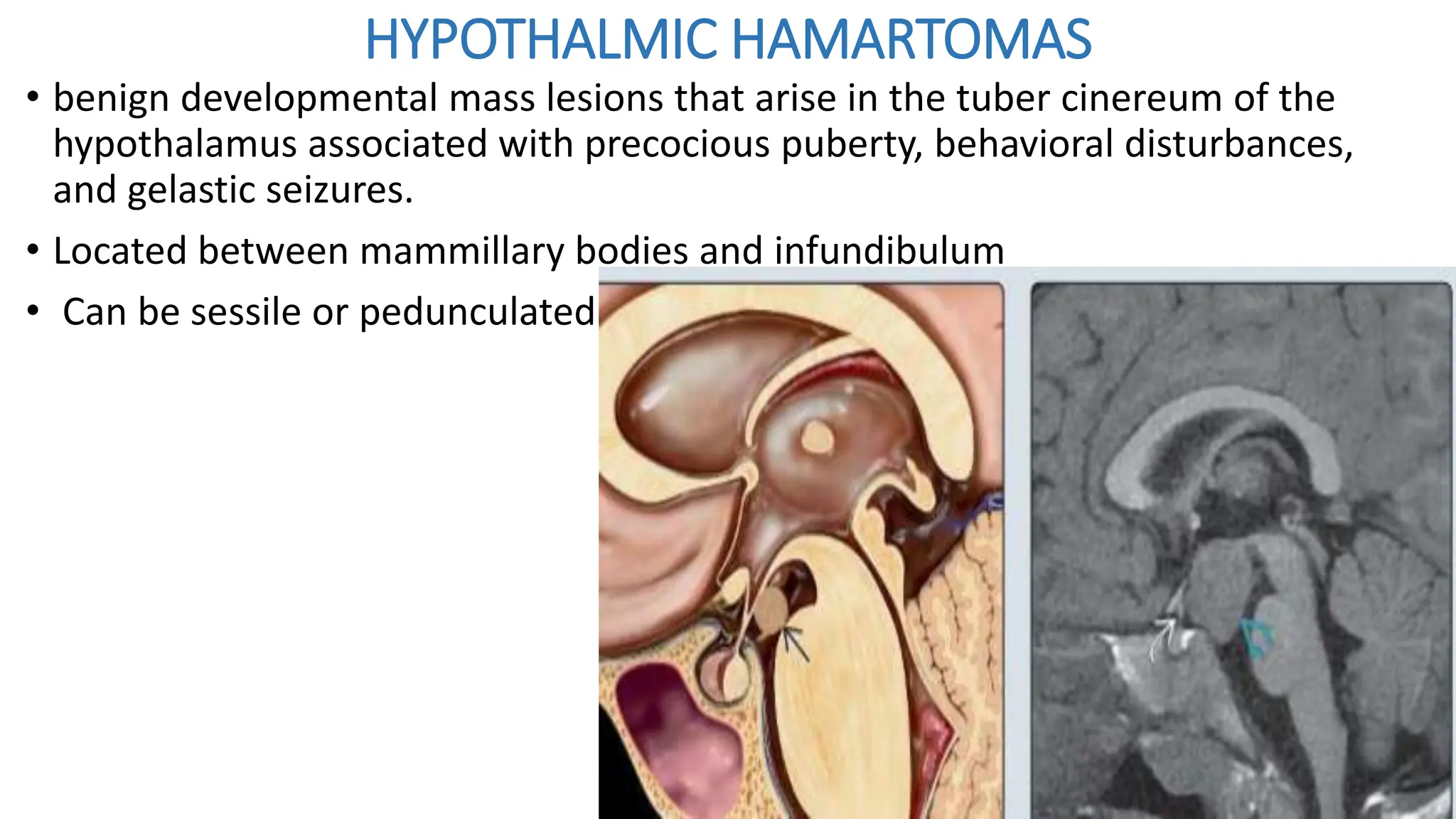sellar and suprasellar mass pituitary gland .pptx