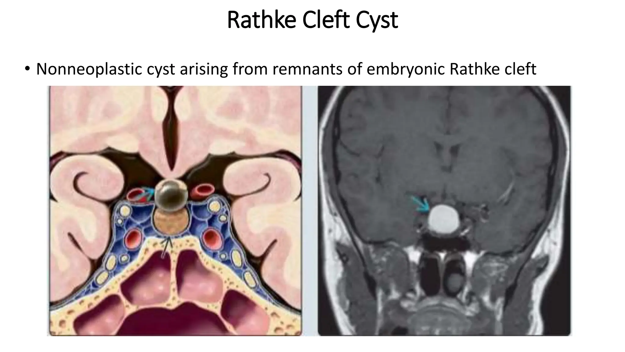 sellar and suprasellar mass pituitary gland .pptx
