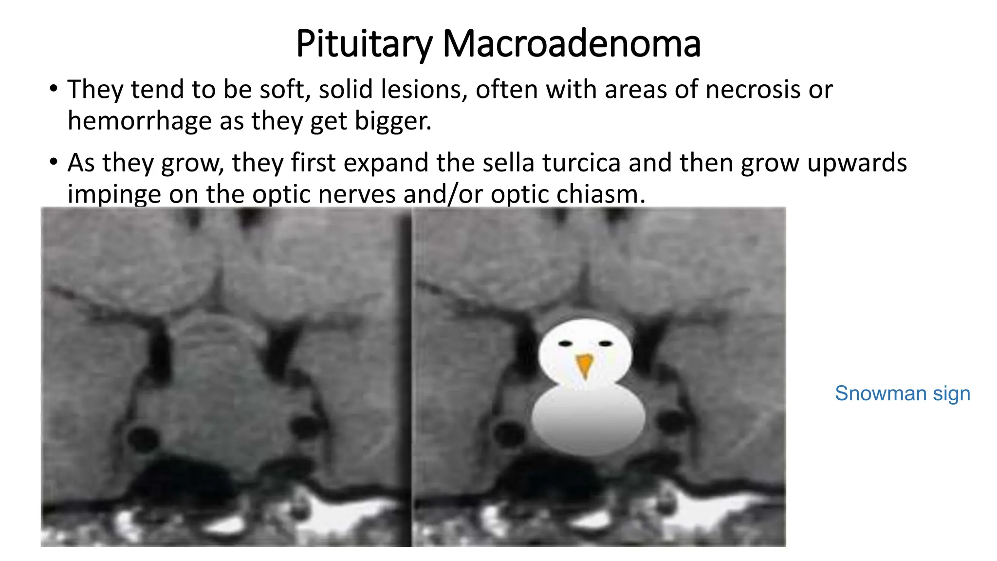 sellar and suprasellar mass pituitary gland .pptx