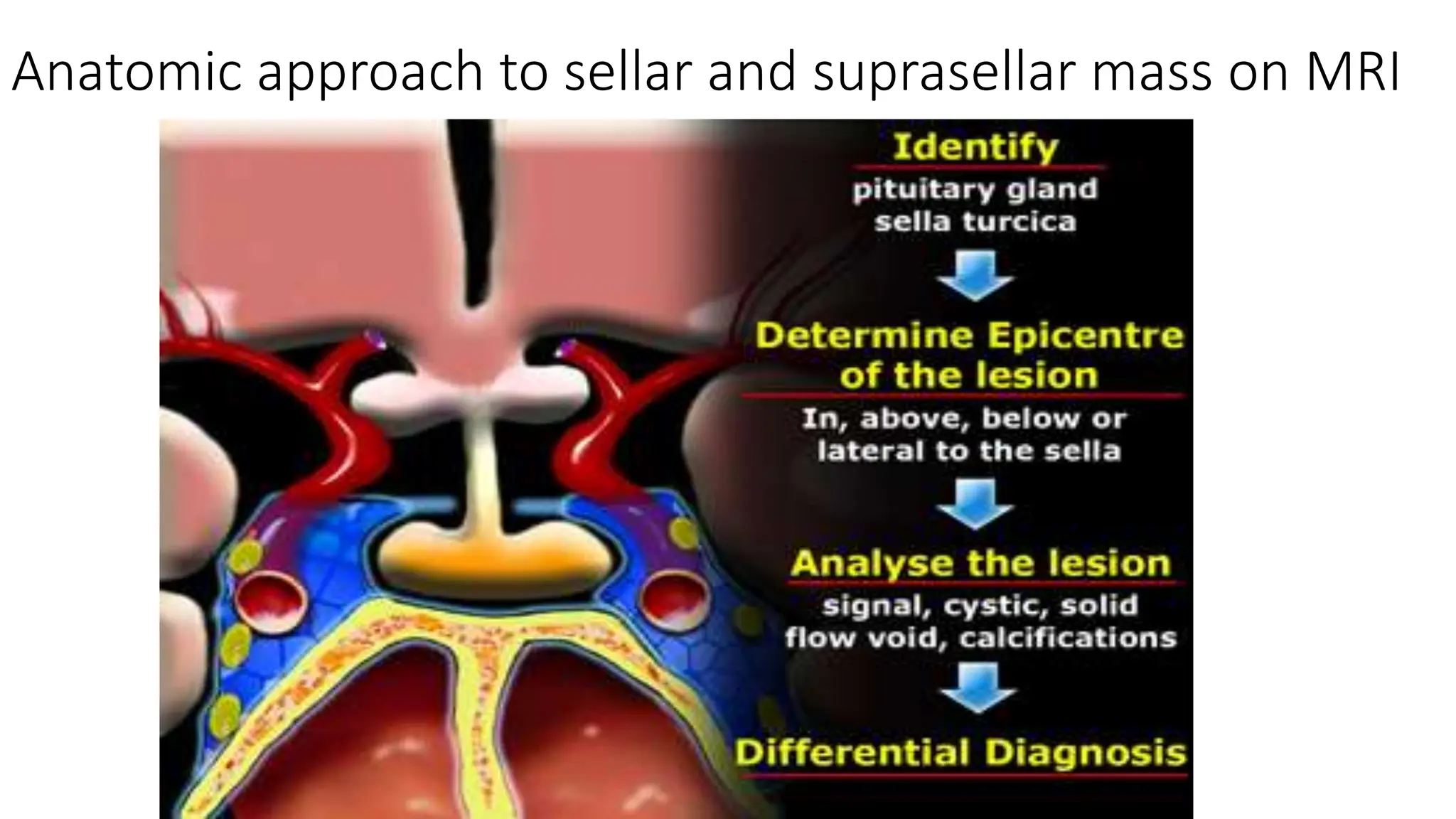Sellar And Suprasellar Mass Pituitary Gland Pptx