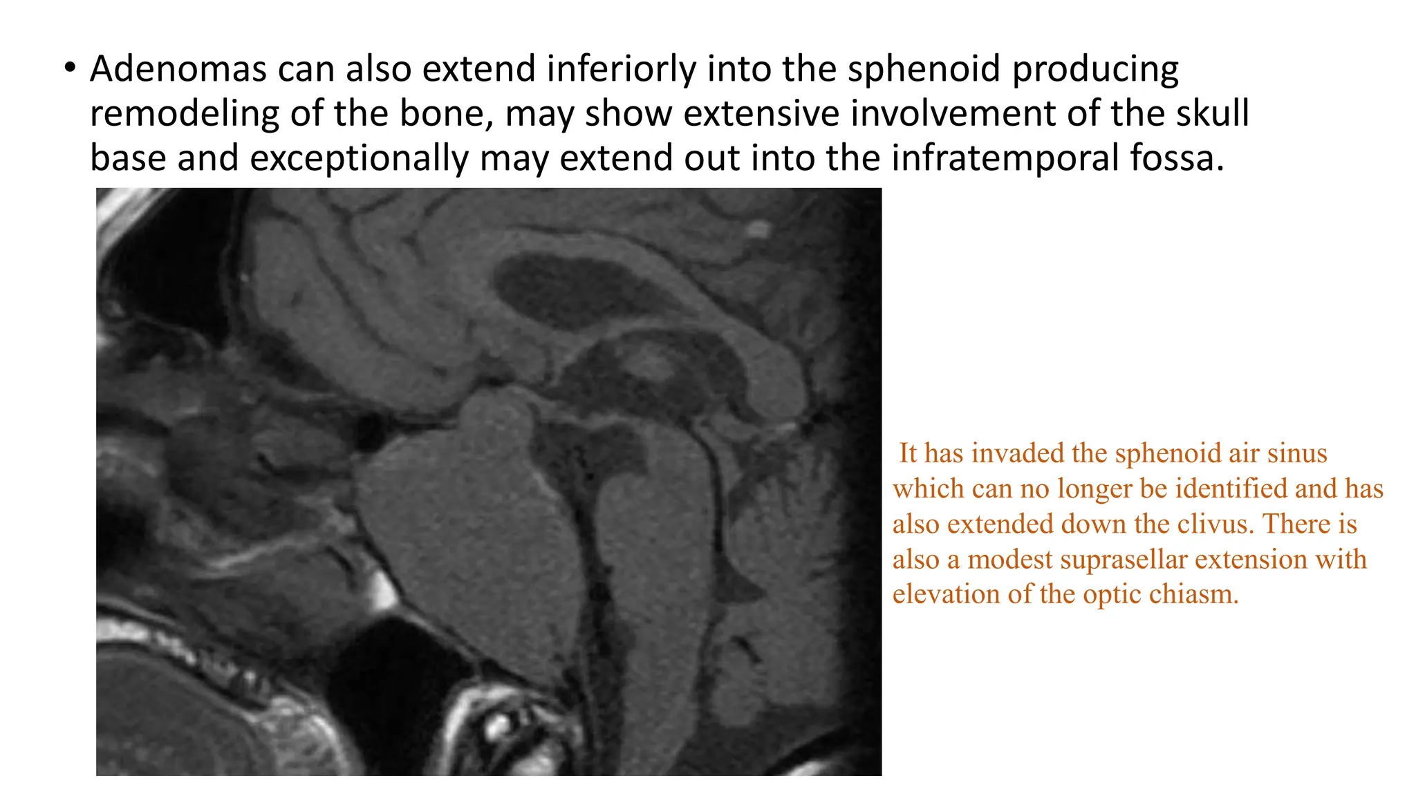 sellar and suprasellar mass pituitary gland .pptx