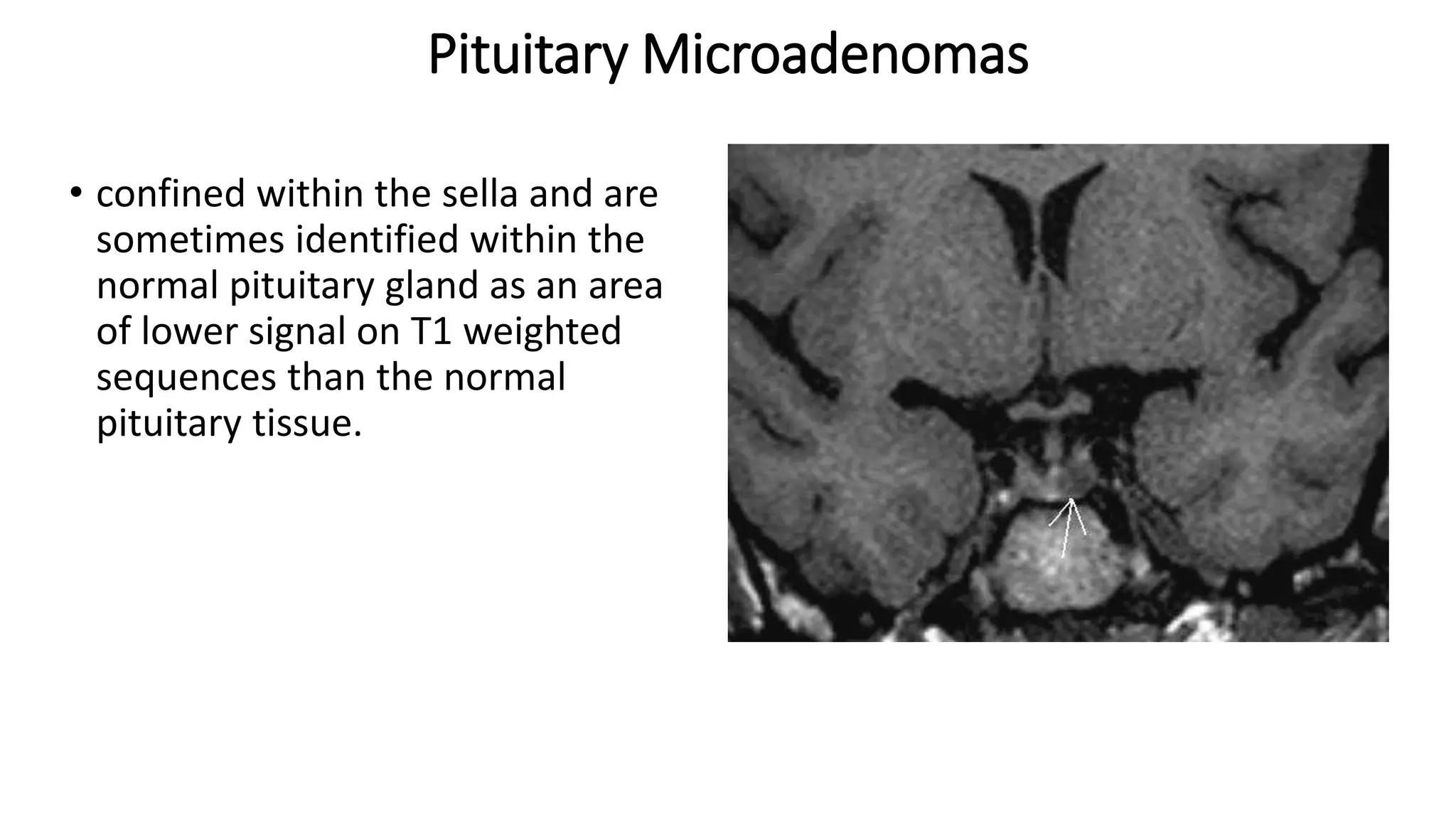 sellar and suprasellar mass pituitary gland .pptx | Endocrine and ...