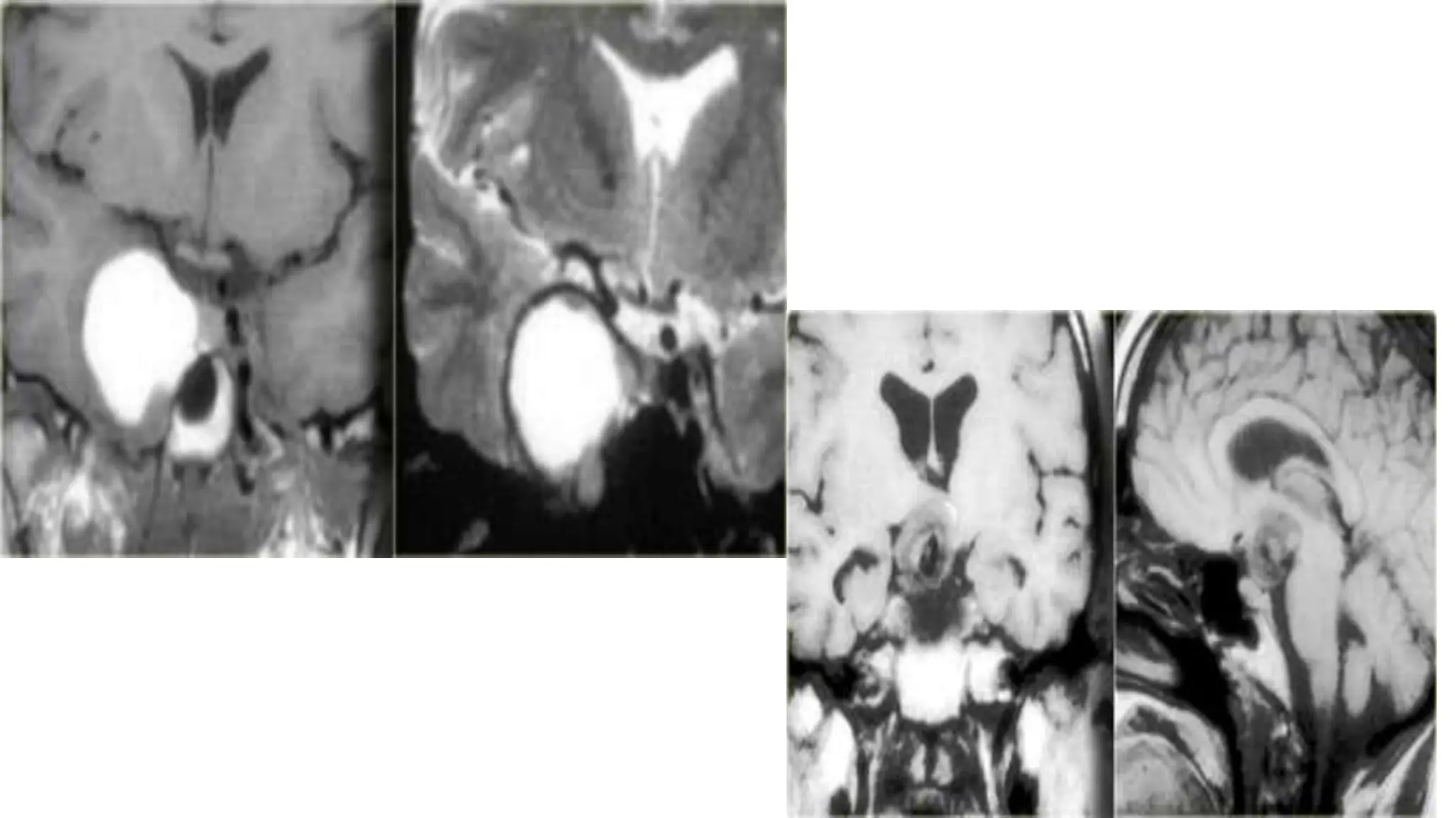 sellar and suprasellar mass pituitary gland .pptx