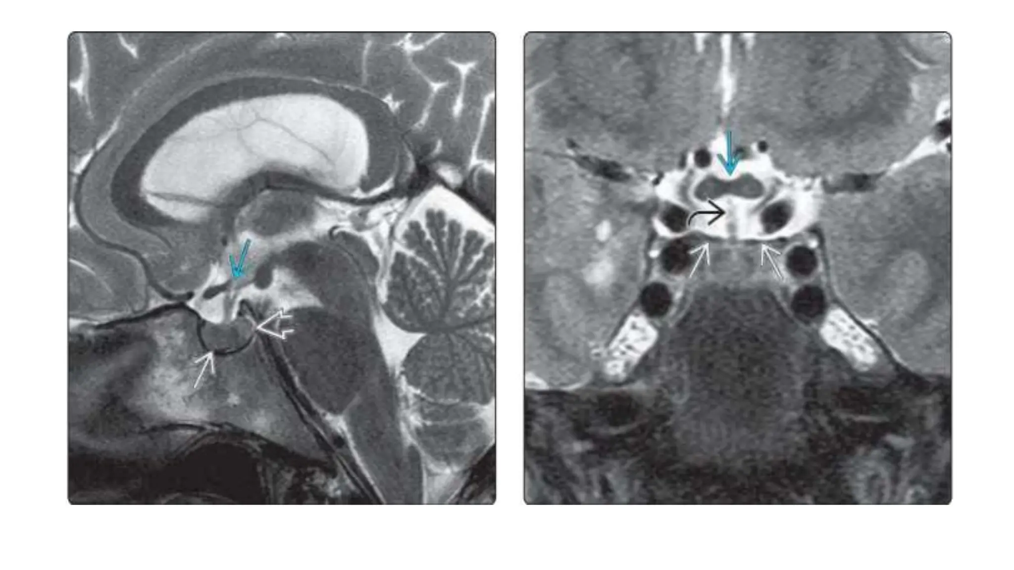 sellar and suprasellar mass pituitary gland .pptx