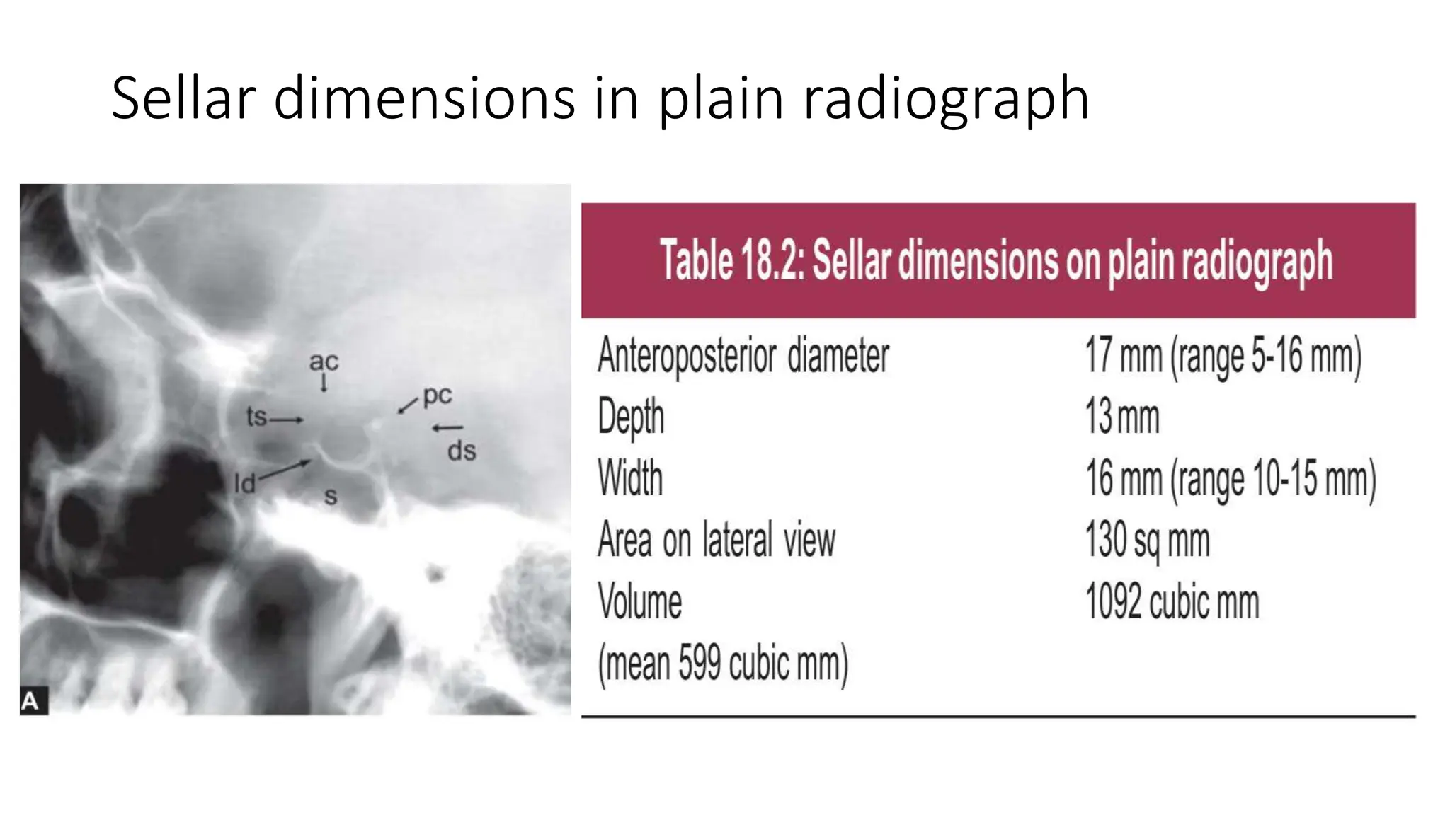 sellar and suprasellar mass pituitary gland .pptx