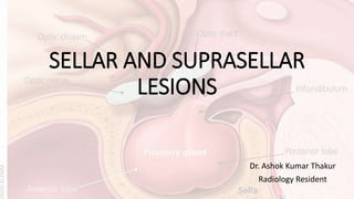 sellar and suprasellar mass pituitary gland .pptx | Endocrine and ...