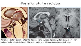 sellar and suprasellar mass pituitary gland .pptx
