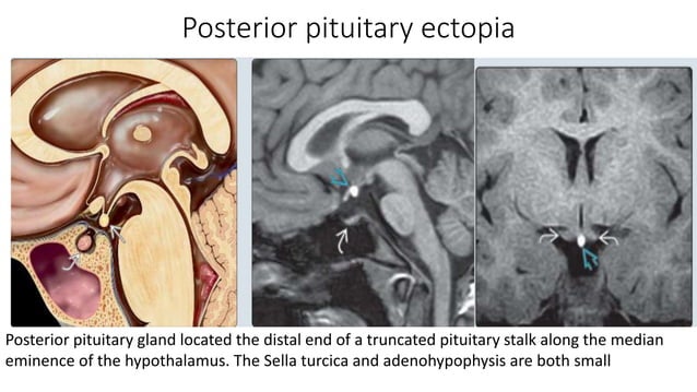 sellar and suprasellar mass pituitary gland .pptx | Endocrine and ...
