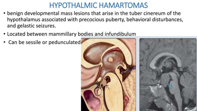 sellar and suprasellar mass pituitary gland .pptx | Endocrine and ...