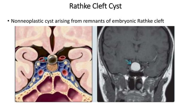 sellar and suprasellar mass pituitary gland .pptx | Endocrine and ...
